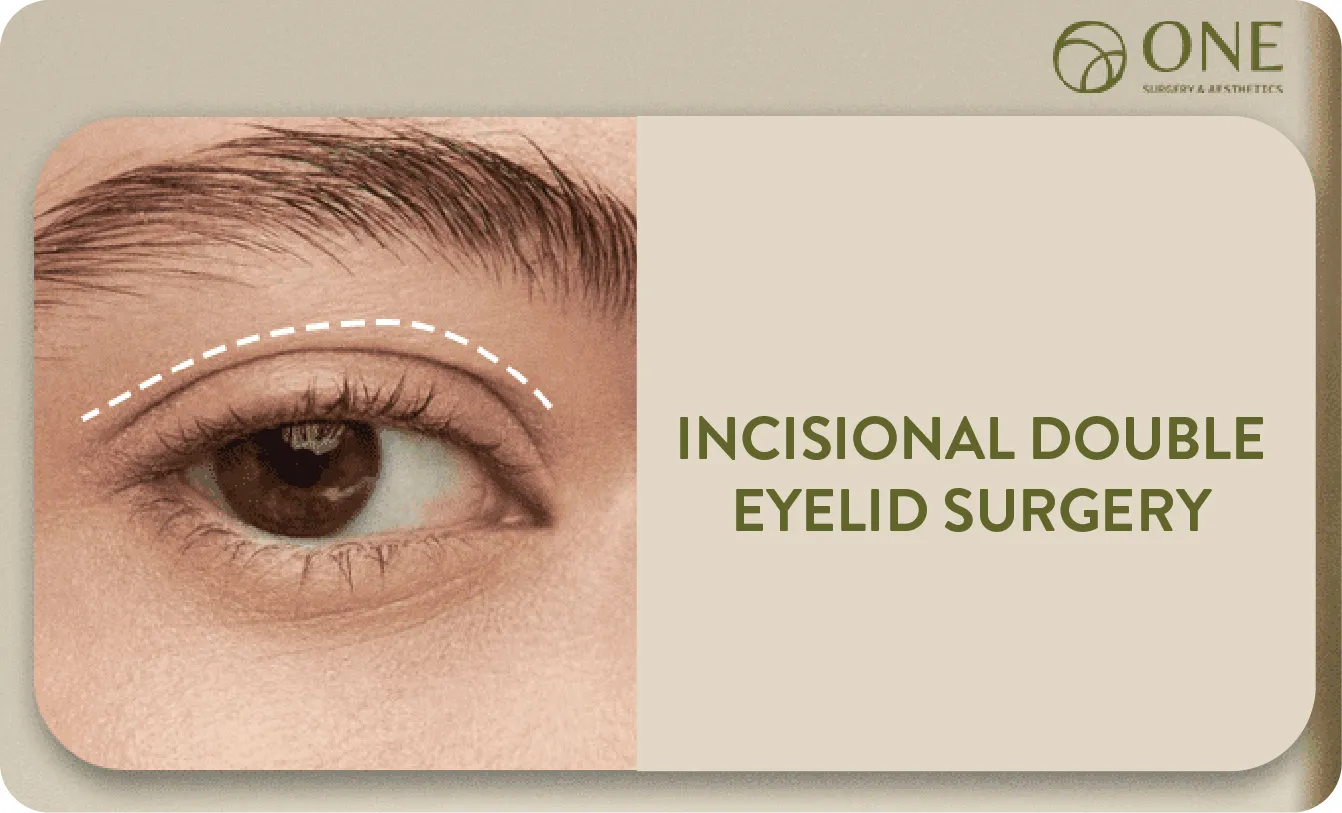 Incisional Double Eyelid Surgery - ONE Clinic Surgery & Aesthetics