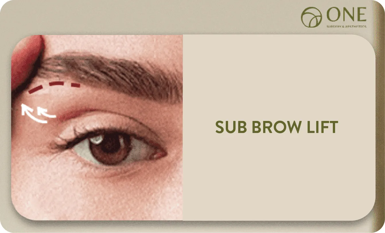 Sub-brow lift - ONE Clinic Surgery & Aesthetics