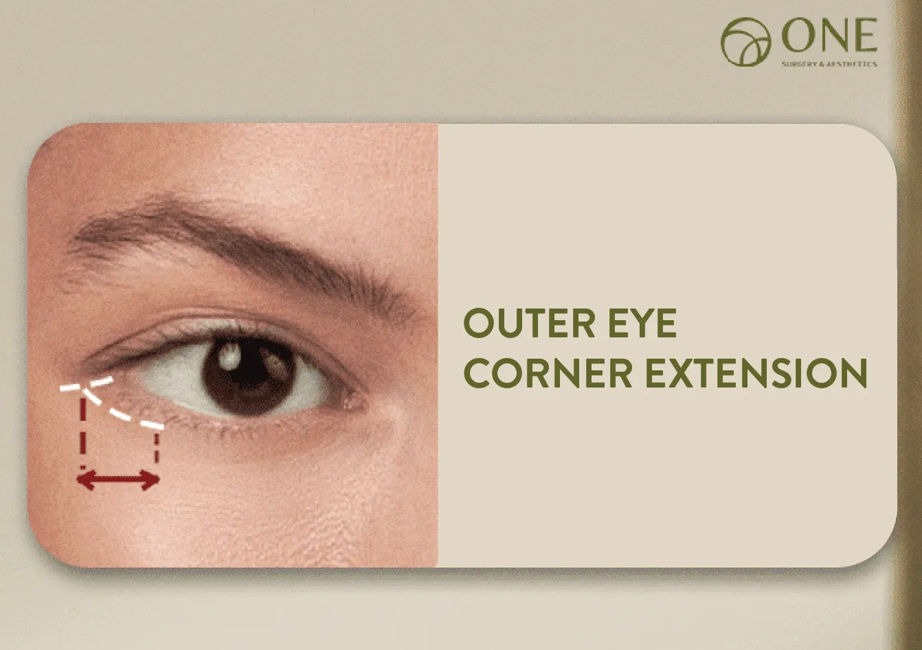 Outer eye corner extension - ONE Clinic Surgery & Aesthetics